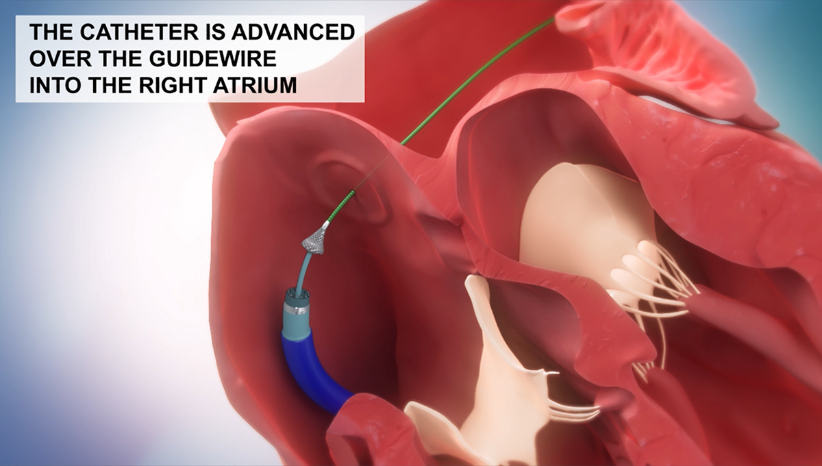 No-Implant Shunt for HF Looks Safe, Feasible in Early Snapshot | tctmd.com